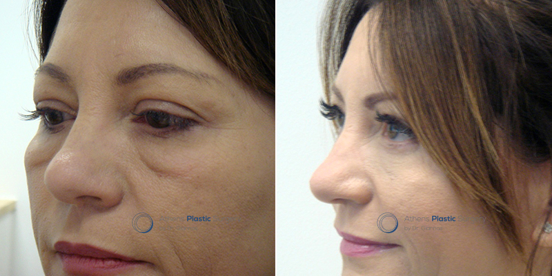 Βλεφαροπλαστική - Athensplasticsurgery | By Dr. Giannas