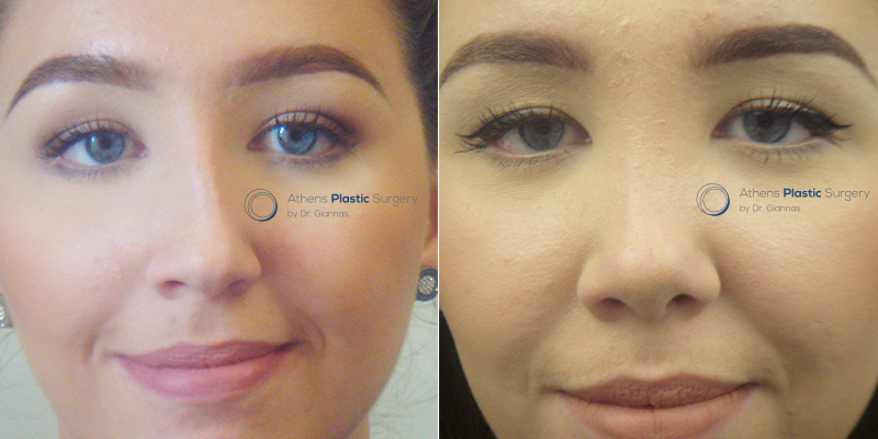 Nose Reshaping Rhinoplasty - Athensplasticsurgery | By Dr. Giannas