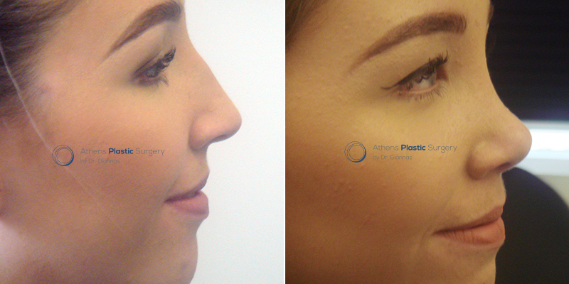 Ρινοπλαστική - Athensplasticsurgery | By Dr. Giannas