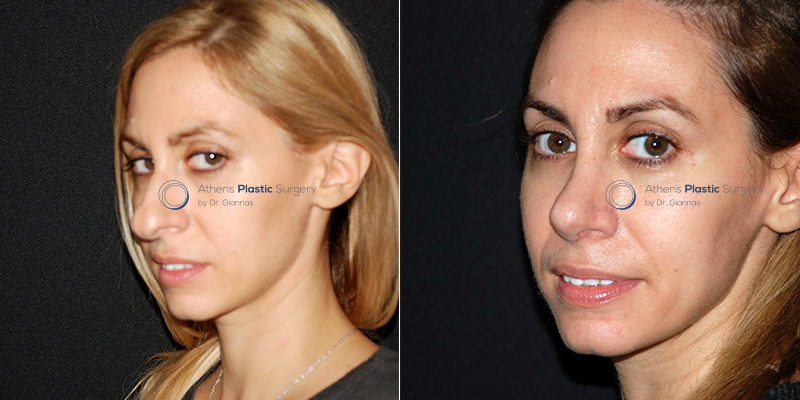 Ρινοπλαστική - Athensplasticsurgery | By Dr. Giannas