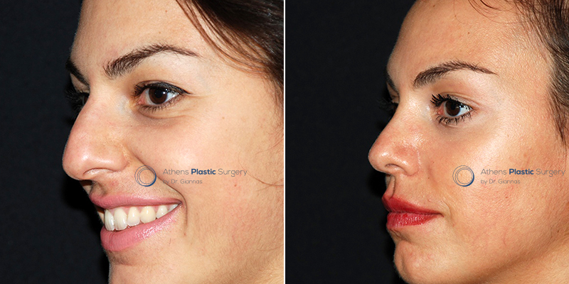 Ρινοπλαστική - Athensplasticsurgery | By Dr. Giannas