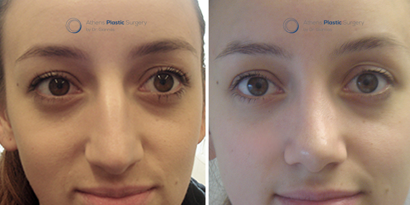 Ρινοπλαστική - Athensplasticsurgery | By Dr. Giannas